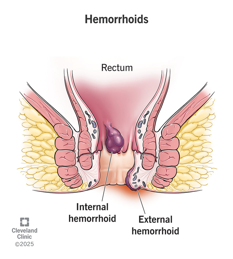 Prolaps Hemorroide Prolaps Hemorroide