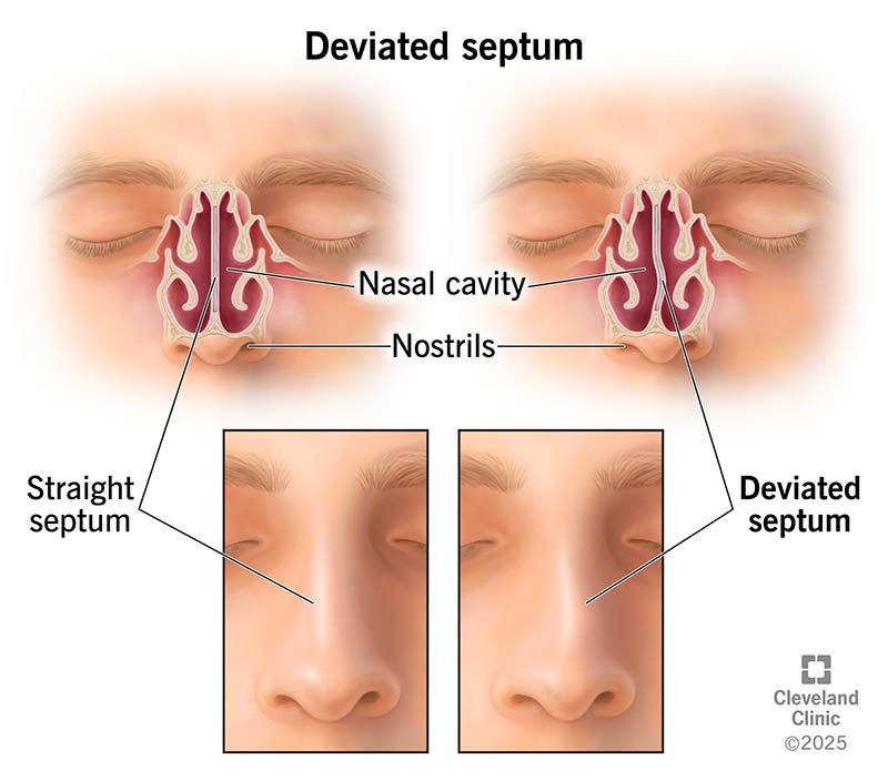 Deviated Septum Symptoms Outlet Cityofclovis