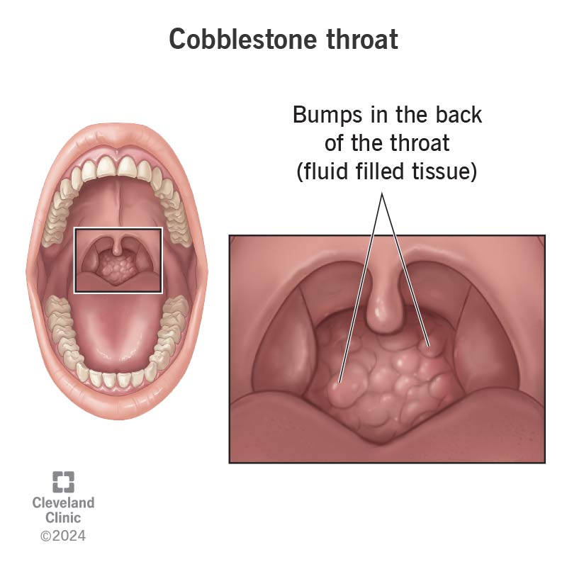 Cobblestone Throat Sore Throat On One Side XR Causes And When To See