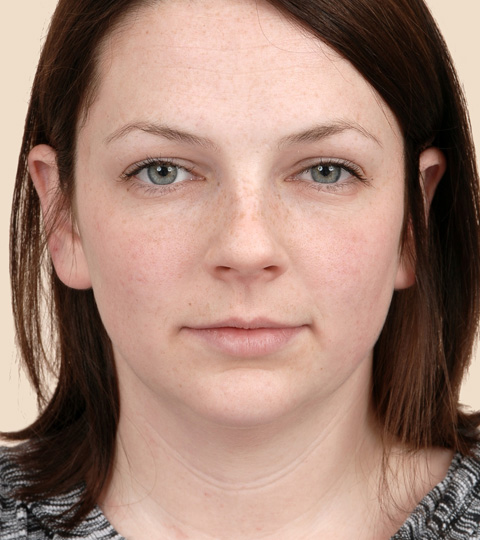 Facial & Chin Implants: Plastic Surgery | Cleveland Clinic