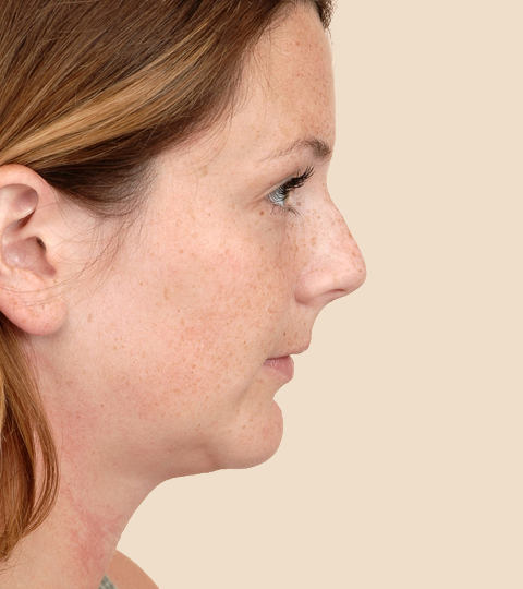 Facial & Chin Implants: Plastic Surgery | Cleveland Clinic