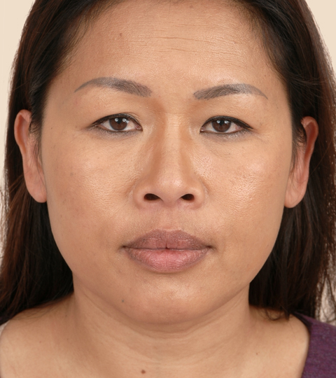 Facial & Chin Implants: Plastic Surgery | Cleveland Clinic