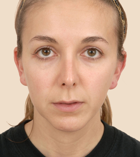 Facial & Chin Implants: Plastic Surgery | Cleveland Clinic