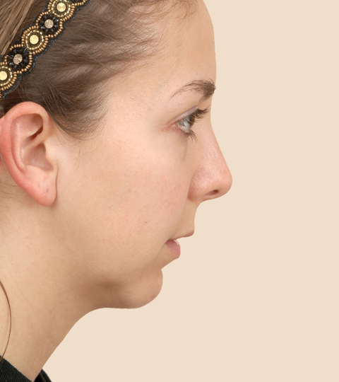 Facial & Chin Implants: Plastic Surgery | Cleveland Clinic