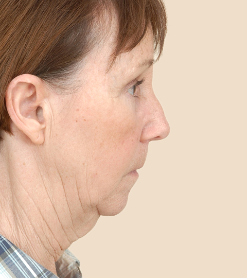 Facial & Chin Implants: Plastic Surgery | Cleveland Clinic