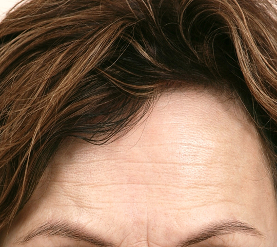 Forehead/Eyebrow Lift: Plastic Surgery | Cleveland Clinic
