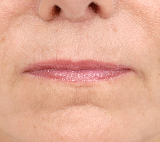 Lip Lift Surgery: Plastic Surgery | Cleveland Clinic