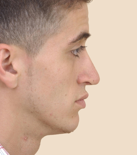 Cosmetic Nose Surgery : Rhinoplasty | Cleveland Clinic