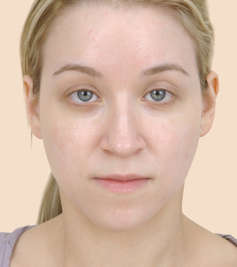 Cosmetic Nose Surgery : Rhinoplasty | Cleveland Clinic