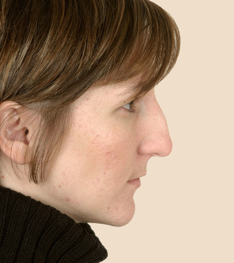 Cosmetic Nose Surgery : Rhinoplasty | Cleveland Clinic