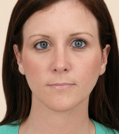 Cosmetic Nose Surgery : Rhinoplasty | Cleveland Clinic