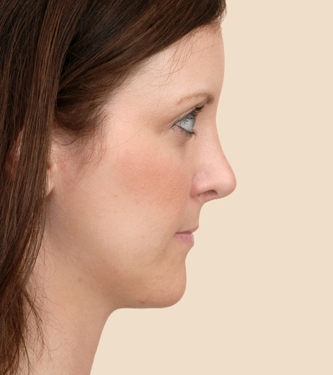 Cosmetic Nose Surgery : Rhinoplasty | Cleveland Clinic