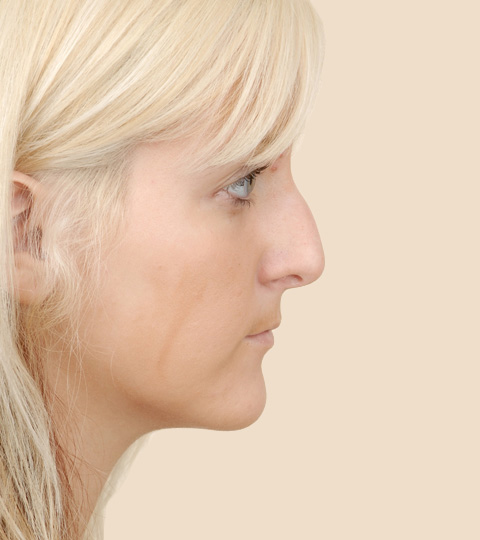 Cosmetic Nose Surgery : Rhinoplasty | Cleveland Clinic