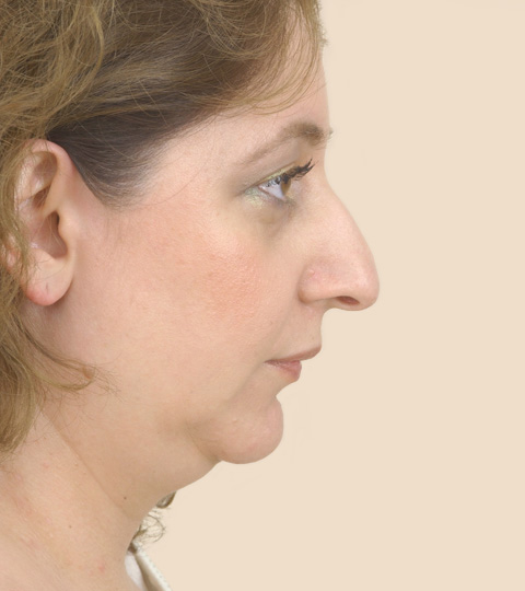 Cosmetic Nose Surgery : Rhinoplasty | Cleveland Clinic