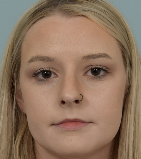 Cosmetic Nose Surgery : Rhinoplasty | Cleveland Clinic