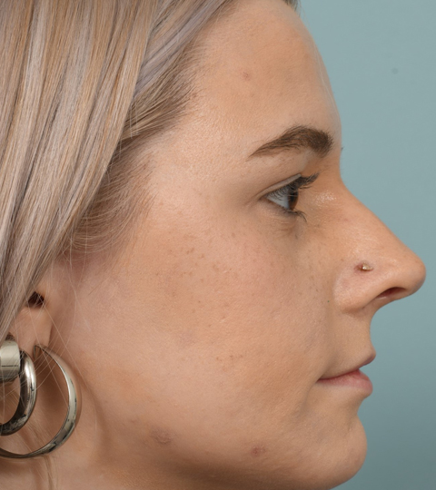 Cosmetic Nose Surgery : Rhinoplasty | Cleveland Clinic