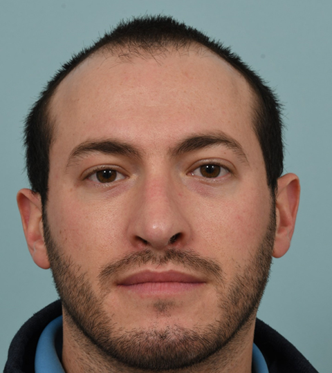 Cosmetic Nose Surgery : Rhinoplasty | Cleveland Clinic