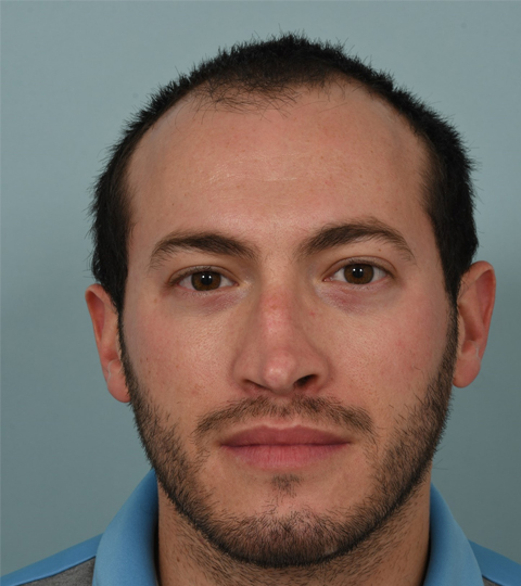 Cosmetic Nose Surgery : Rhinoplasty | Cleveland Clinic