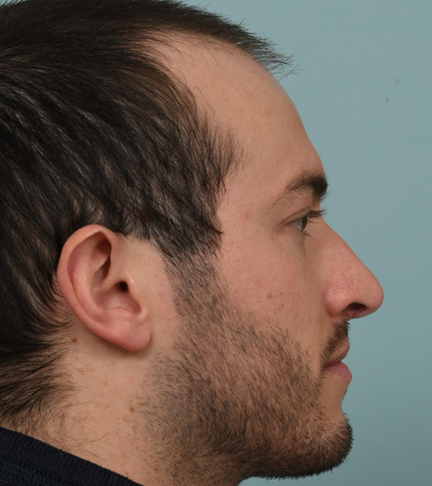 Cosmetic Nose Surgery : Rhinoplasty | Cleveland Clinic