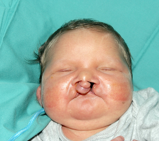 Cleft Lip-Palate and Craniofacial Program | Cleveland Clinic
