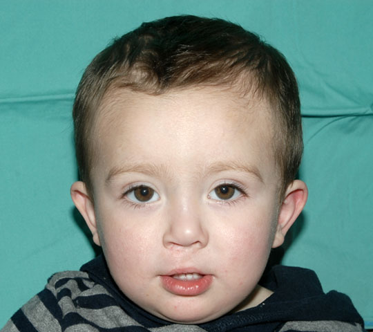 Cleft Lip-Palate and Craniofacial Program | Cleveland Clinic