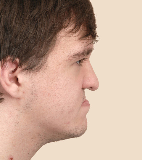 Orthognathic Surgery (Jaw Surgery) Program | Cleveland Clinic