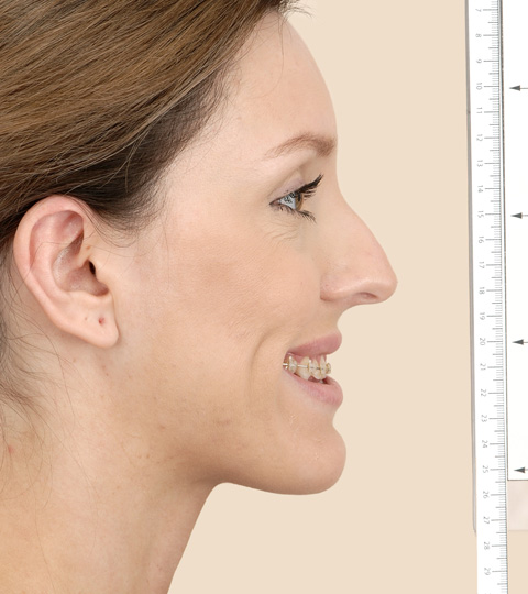 Orthognathic Surgery (Jaw Surgery) Program | Cleveland Clinic
