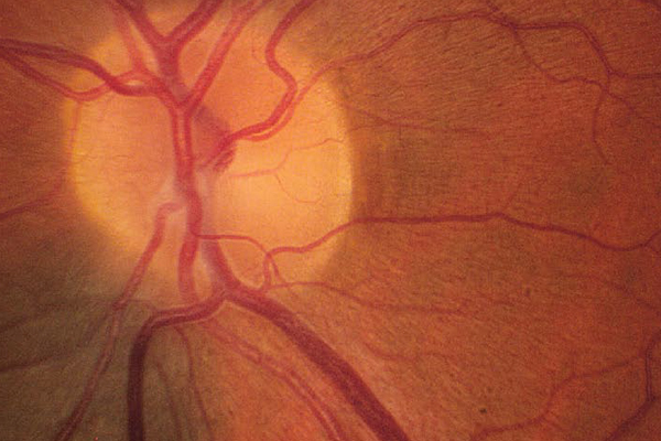 Glaucoma: Treatments | Cleveland Clinic