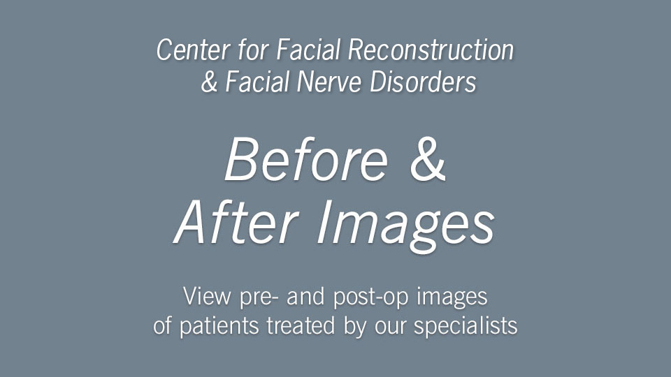 Facial Reanimation and Management of Facial Nerve Disorders | Cleveland ...