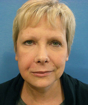 Head and Neck Cancer Reconstruction | Cleveland Clinic