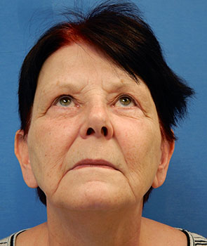 Head and Neck Cancer Reconstruction | Cleveland Clinic