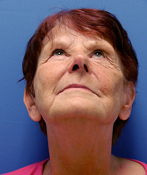 Head and Neck Cancer Reconstruction | Cleveland Clinic