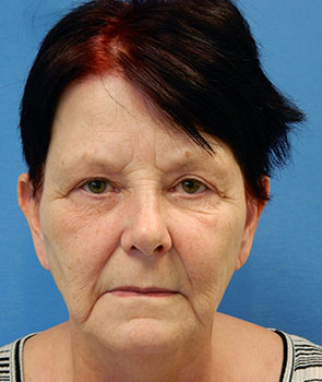 Head and Neck Cancer Reconstruction | Cleveland Clinic