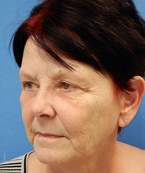 Head and Neck Cancer Reconstruction | Cleveland Clinic