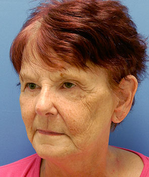 Head and Neck Cancer Reconstruction | Cleveland Clinic