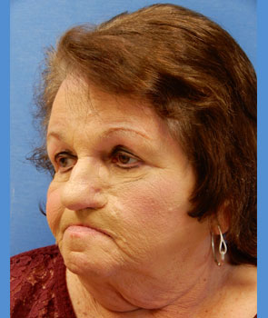 Skin Cancer Reconstruction | Cleveland Clinic