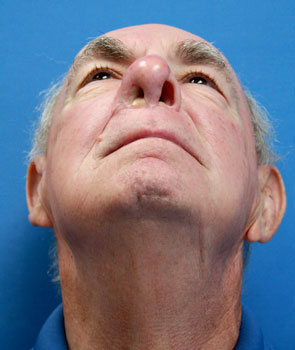 Skin Cancer Reconstruction | Cleveland Clinic