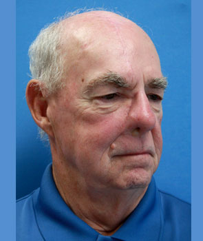 Skin Cancer Reconstruction | Cleveland Clinic