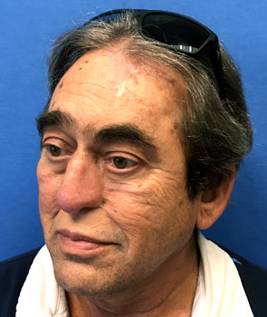 Skin Cancer Reconstruction | Cleveland Clinic