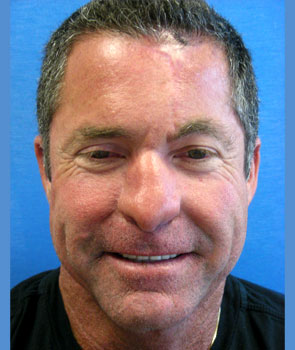 Skin Cancer Reconstruction | Cleveland Clinic