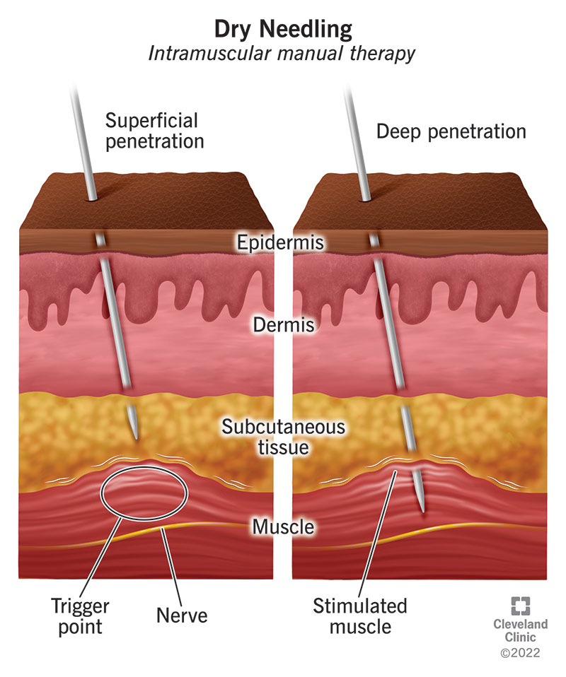 Myofascial Pain Treatment Symptoms Causes And More 51 OFF