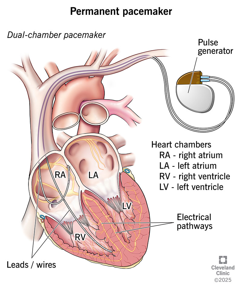 Permanent Leadless Cardiac Pacemaker Therapy Circulation 47 OFF