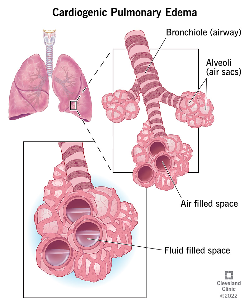 Cardiogenic Pulmonary Edema Causes Symptoms And Treatment