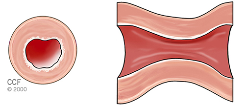 Heart Attack (Myocardial Infarction) Types of Heart Attacks | Cleveland ...