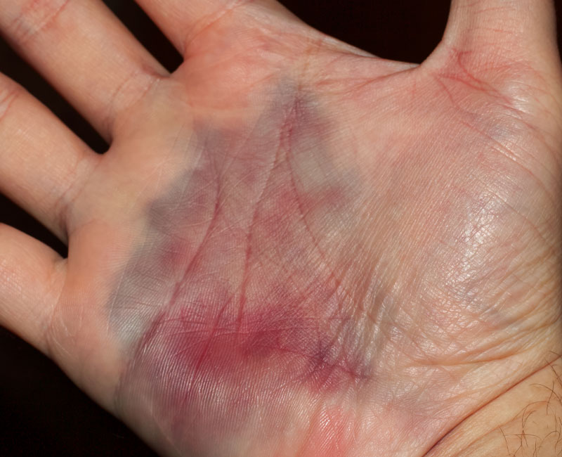 Hematoma Definition Types Treatment