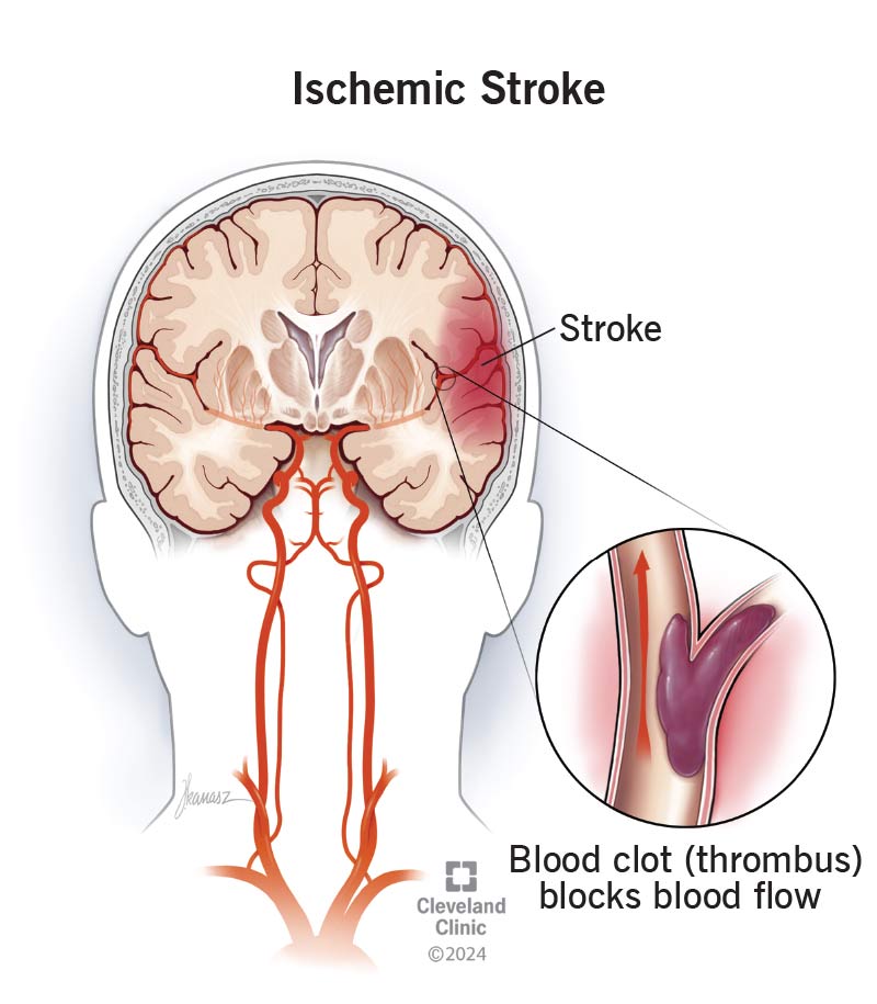 Ischemia Symptoms Preventing Hypoxic Ischemic Encephalopathy HIE 