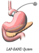 LAP-BAND