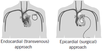 Permanent Pacemaker During the Procedure | Cleveland Clinic