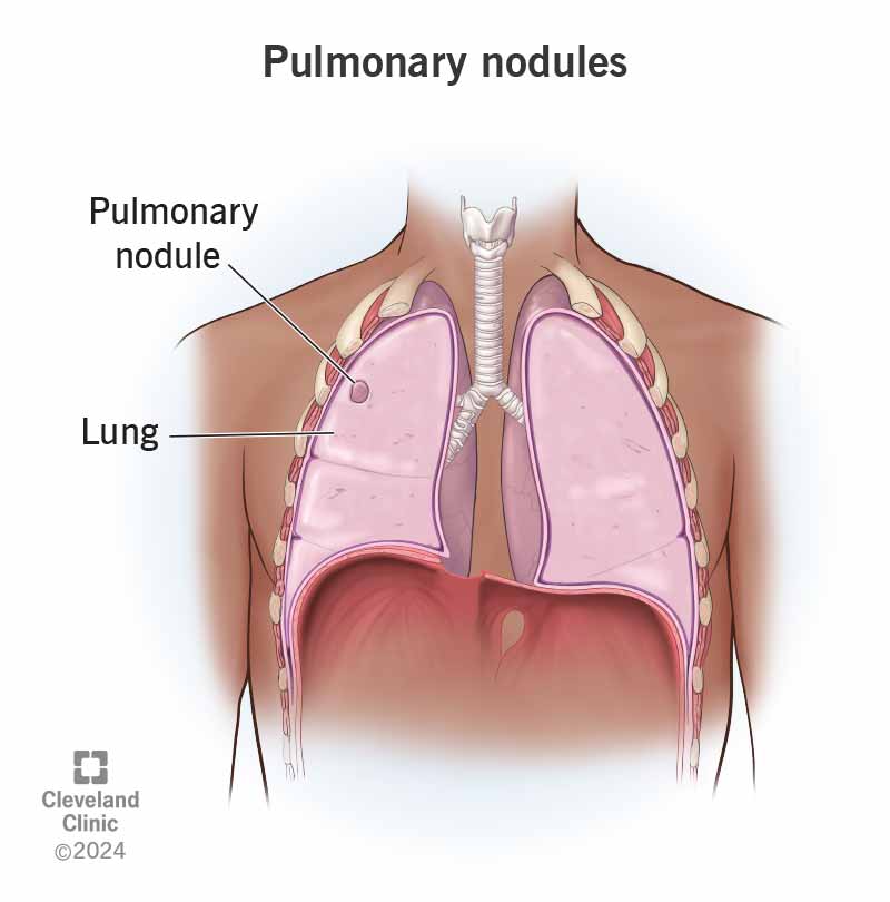 Nodules