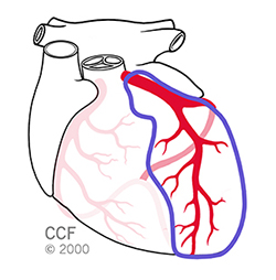 Heart Attack (Myocardial Infarction)
